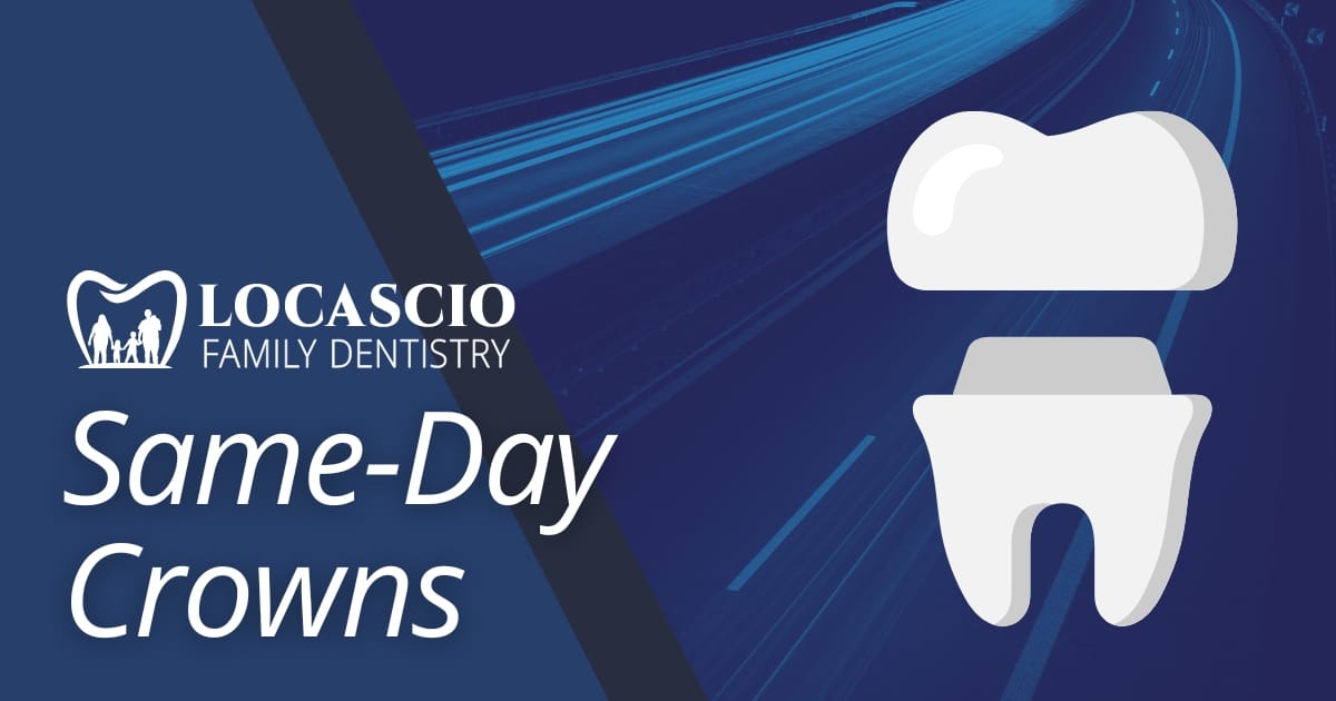 Same-day Crown, Color Match Porcelain Crown via CEREC